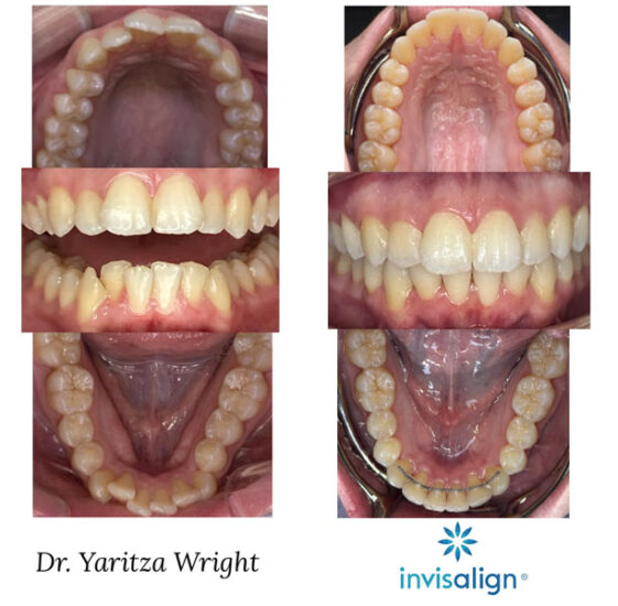 Dentist in Huntsville, AL - Smile Gallery Smiles by Design, PC | Before ...